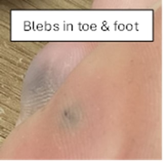 Living with Blue Rubber Bleb Nevus Syndrome; a rare genetic condition ...